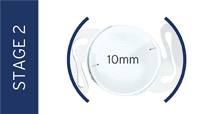 RayOne Trifocal Toric IOL | Rayner Global