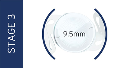 RayOne Trifocal Toric IOL | Rayner Global
