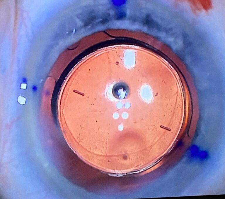 RayOne EMV Premium IOL | Rayner Global